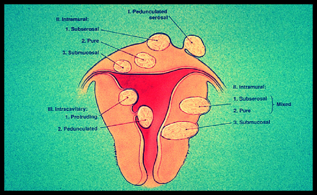 Gynecologic Cancer Awareness And Power Morcellation